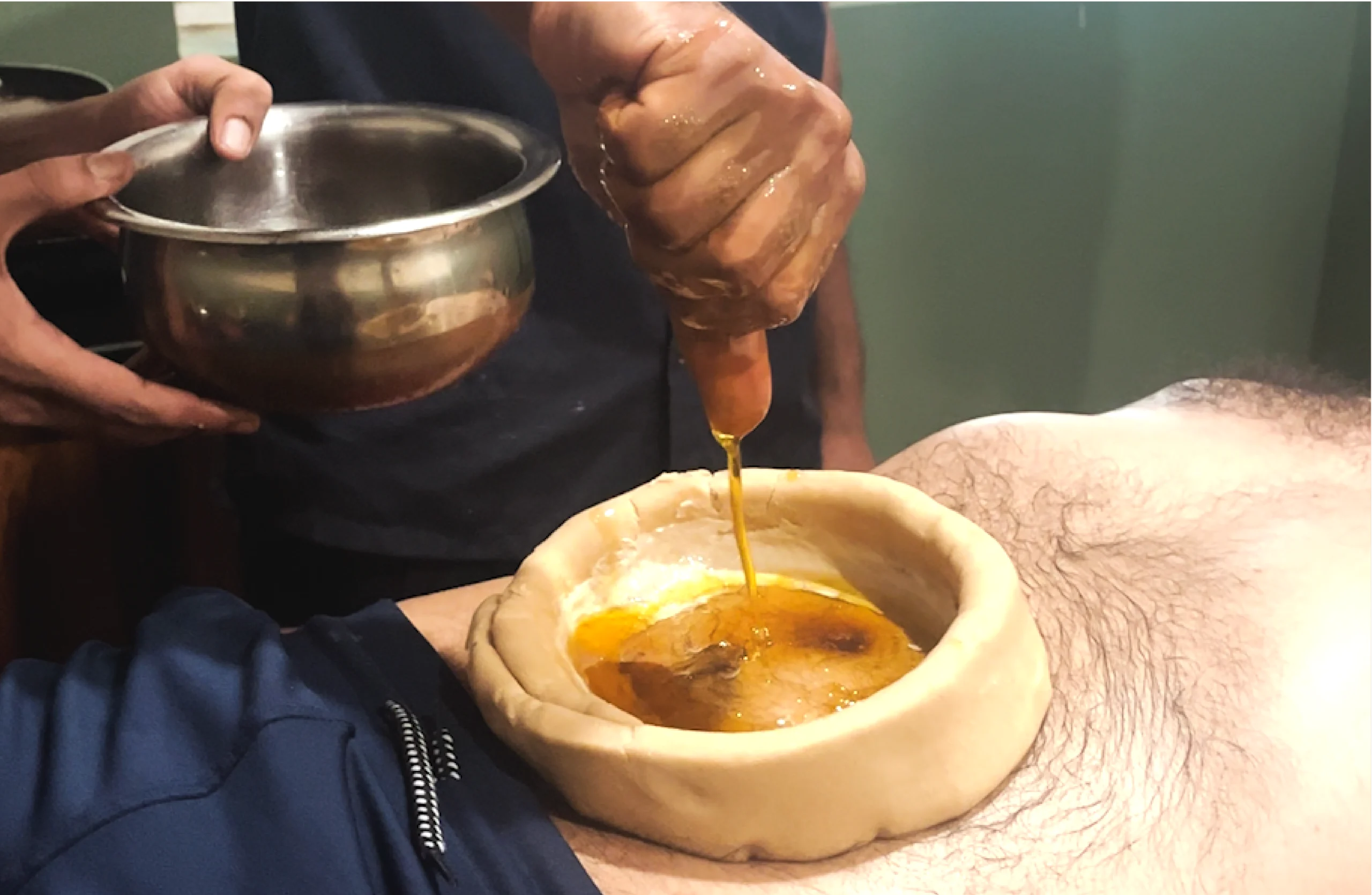 Nabhi Vasti: An Ancient Solution for Modern Gut Health - Autism Ayurvedam